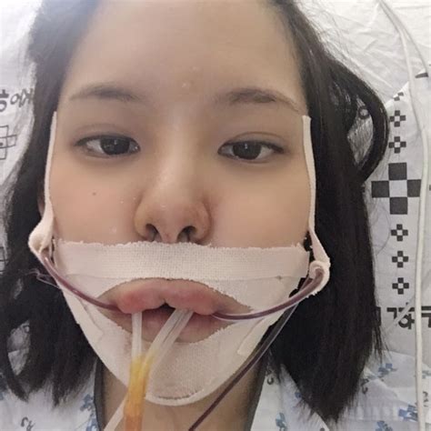 양악 수술 당일 1일차 후기 양악 준비물 네이버 블로그