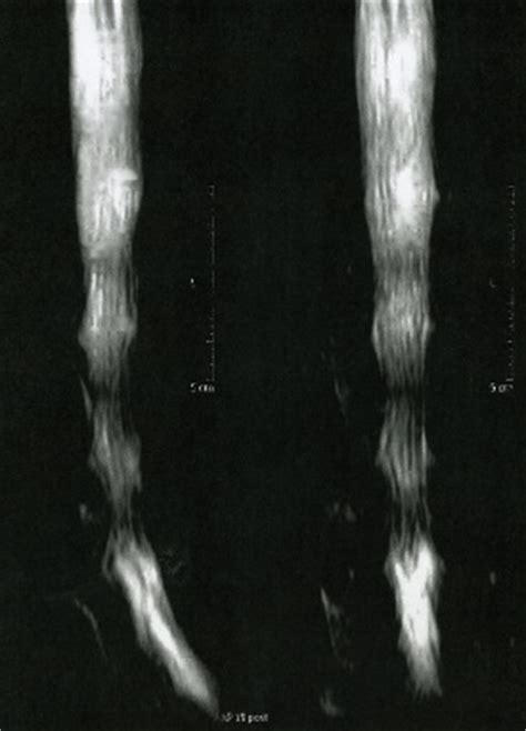 Lumbale Spinalkanalstenose in der Höhe LWK 3/4 und LWK 4/5 ...