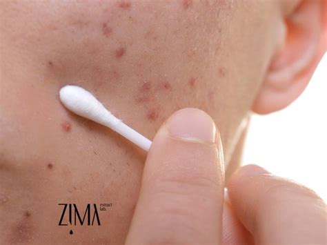 چگونه لکه های قهوه ای جای جوش را از بین ببریم؟ زیمالب