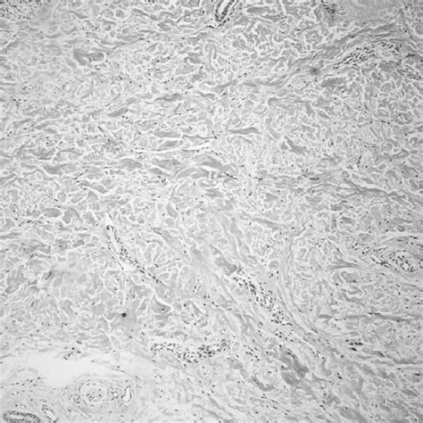 Magnetic Resonance Imaging Showed Fusiform Soft Tissue Swelling Around