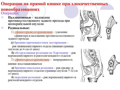 Топография таза и операции на органах таза презентация онлайн