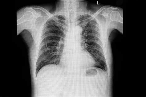 Una Radiografía De Tórax De Un Paciente Con Hamartoma Pulmonar Derecho