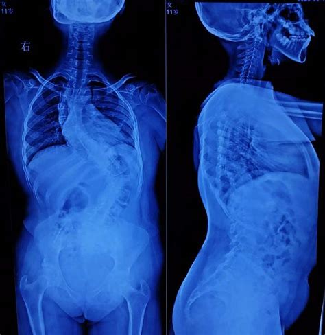 😢小女孩脊柱侧弯，家长需警惕！