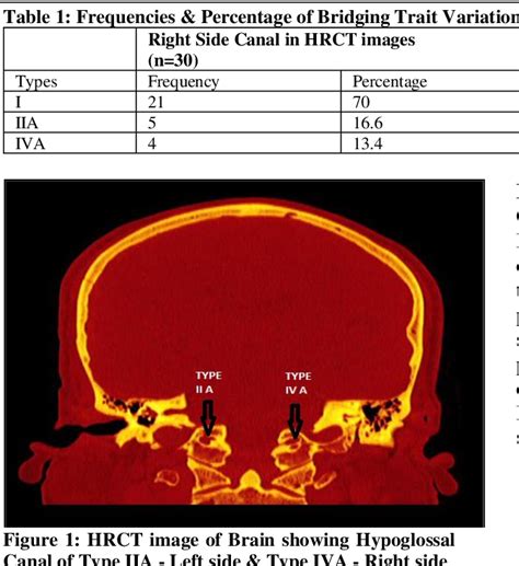 Figure 1 From Bridging Trait Variations Of The Hypoglossal Canal In Dry