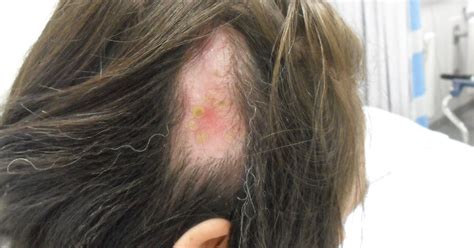 Surviving The Unsurvivable Scalp Operation And 21st Birthday Celebrations