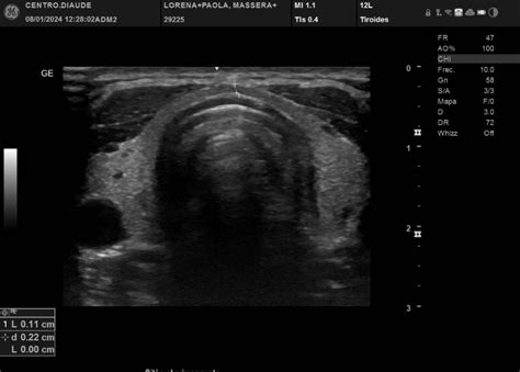 Ecografía De Hígado Procedimiento Explicado