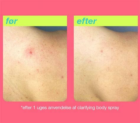 Mød Clear Starts Nye Clarifying Body Spray