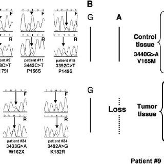A Klf Mutations Identified In Hcc Bidirectional Sequencing