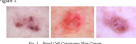Figure From Analysis Of Skin Cancer And Recent Technology Used For