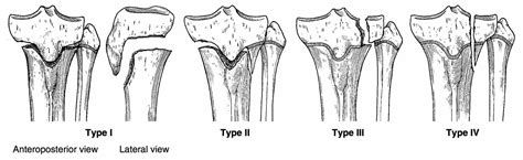 Proximal Tibia Epiphyseal Fractures Pediatric Pediatrics Orthobullets