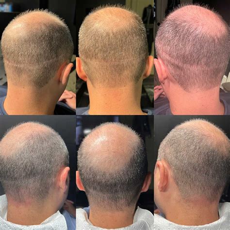 Scar Micropigmentation In Kansas City Mo Scalp Headquarters