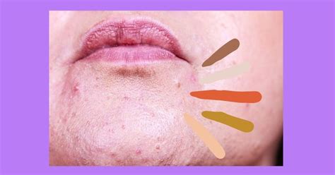 How To Treat Menopause Acne According To An Expert