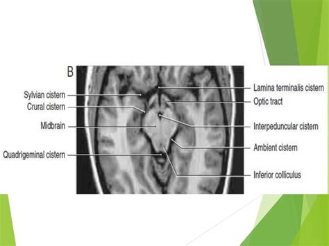 Basal Cisterns Final Ppt