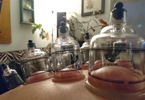 Dry Cupping Therapy Sandra Alonso