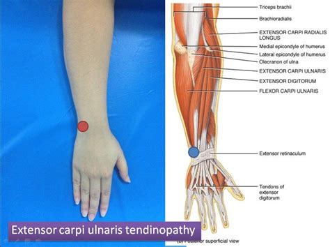 ปวดข้อมือ จุดกดเจ็บช่วยบอกตำแหน่งอักเสบของเส้นเอ็นได้ เส้นเอ็น Tendon บริเวณข้อมือและแขนส่วน