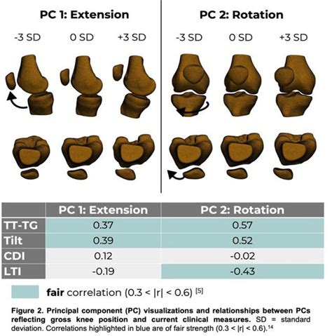 Poster 139 Utilization Of 3d Statistical Shape Modeling Of Anatomic Variation Across A Cohort