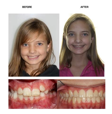 Palate Expander After Braces At Harry Ricks Blog
