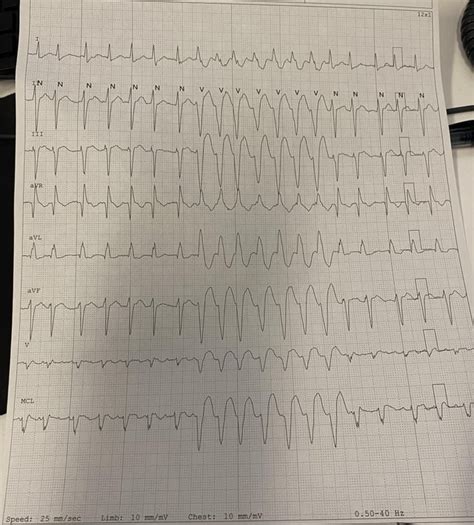 Shortened Pr Interval Rcardiology
