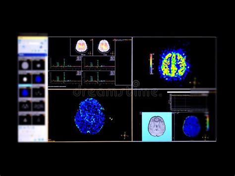 Mra Brain Of Magnetische Resonantie Angiografie Mra Van De Cerebrale