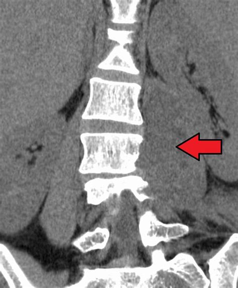 Psoas Muscle Abscess Alchetron The Free Social Encyclopedia