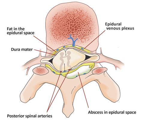 Diagnosing Spinal Epidural Abscesses Emergency Physicians Monthly