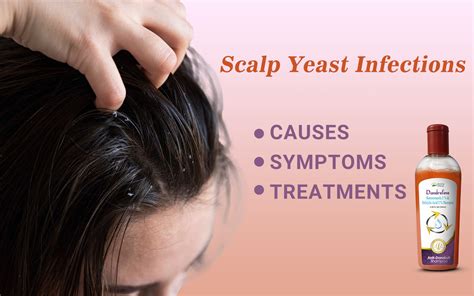 Scalp Yeast Infections Causes Symptoms And Effective Treatments