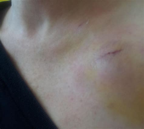 What Does A Double Mastectomy Look Like After Surgery At Hunter Coningham Blog