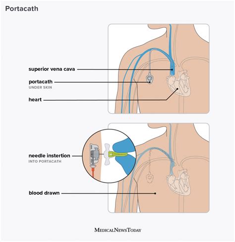 Portacath What Is It Why Is It Used And More