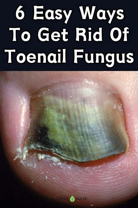 How To Get Rid Of Fungal Toenails Foot Fungus Remedies How To Get Rid