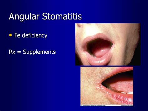 Ppt Extra Gi Manifestations Of Ibd Powerpoint Presentation Id 2777829