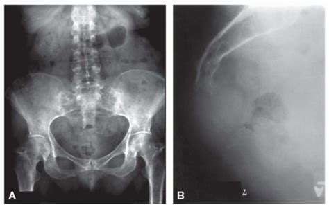 Chordoma X Ray