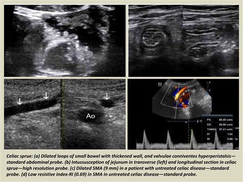 Presentation1 Ultrasound Of The Bowel Loops And The Lymph Nodespptx