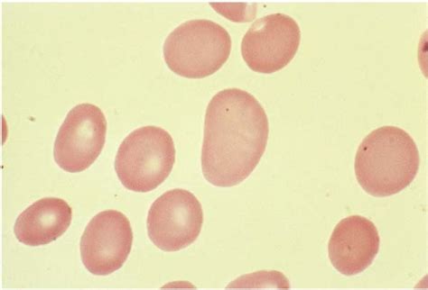 Macrocytic Anaemias Haematology Flashcards Quizlet