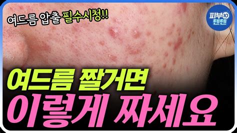 여드름 압출 이것만 보세요 여드름 짠 뒤 후 홈케어 관리법 피부과 전문의 Youtube
