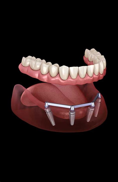 Snap In Implant Dentures Kaizen Dental Center