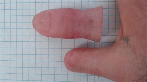 Thumb Prosthesis 12 Steps With Pictures Instructables