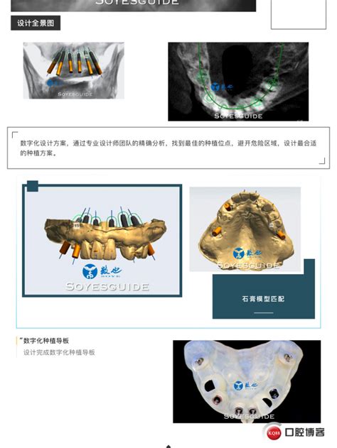 上颌即刻负重导板辅助种植病例 杭州数也医疗的博客 Kq88口腔博客