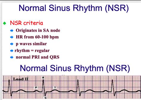 Sinus Arrhythmia