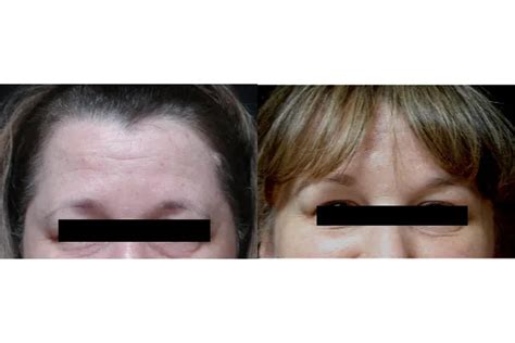 Brow Lift For View Obstruction Associates In Plastic Surgery