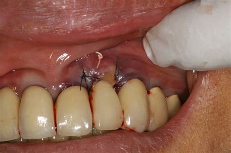 Jojoe79 S Dental Clinic Record Root Coverage Tunnel Method Ctg