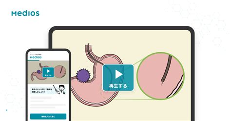 内視鏡治療・ercpのわかりやすい説明を｜medios 動画説明