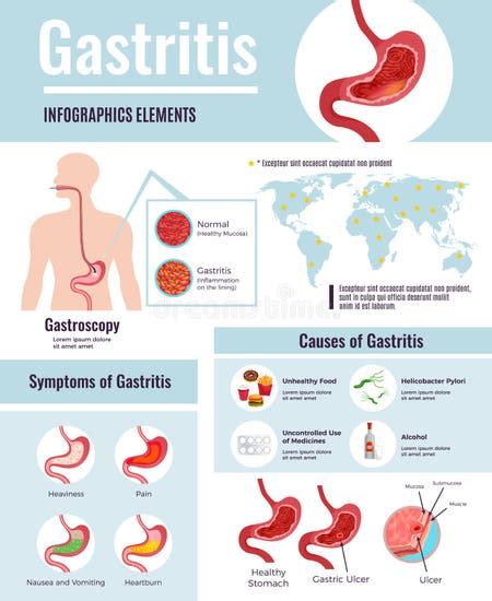 Gastritis Infographic Poster Stock Vector Illustration Of Alcohol