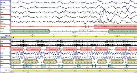 7 Typical Psg With The Raw Data Showing In The Upper Part 30 S Epoch