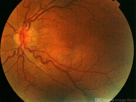 Venous Loop Retina Image Bank