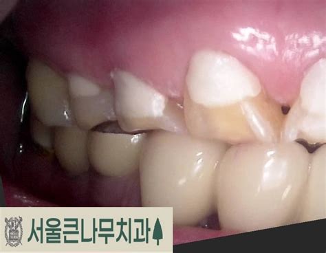 치아 마모와 교모로 인한 크라운 치료