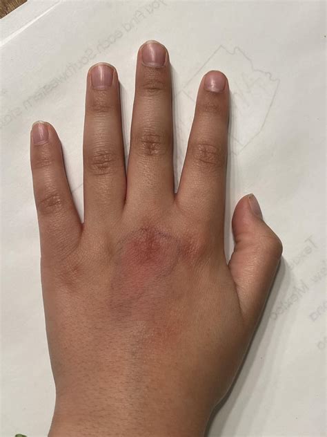 Mysterious Rash Rdermatologyquestions