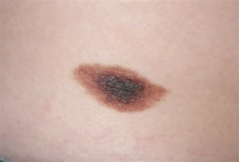Nevus Melanocytic Congenital Congenital Melanocytic Nevus Dlyg