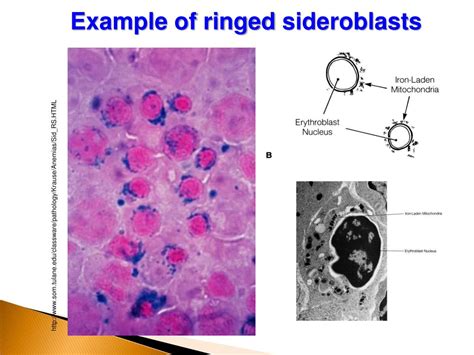 Ppt Sideroblastic Anemias Powerpoint Presentation Free Download Id