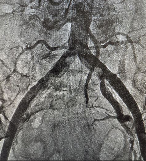 Reducing The Radial To Peripheral Gender Gap With 5 Fr Guide Sheaths Endovascular Today