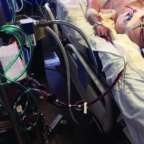 Approach To Hypoxia During VV ECMO VV ECMO Venovenous Extracorporeal Download Scientific